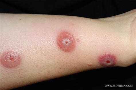 Acute Febrile Neutrophilic Dermatosis Home