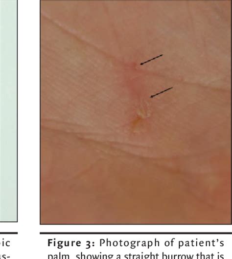 Figure 3 From Diagnosis Of Scabies With Dermoscopy Semantic Scholar