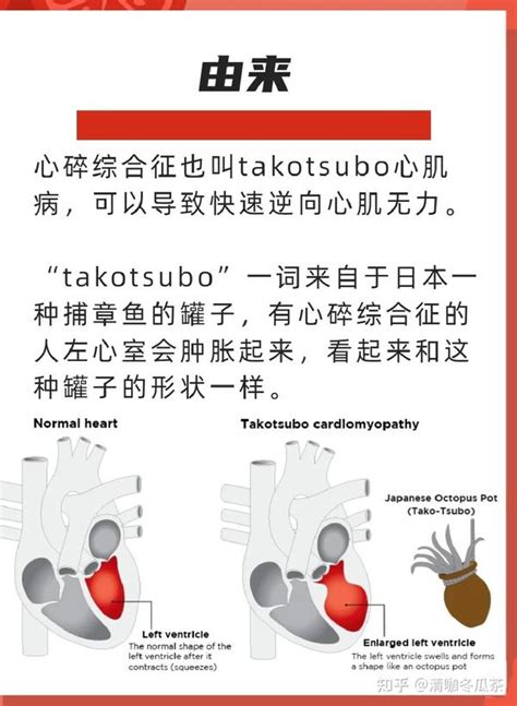 心碎综合征破心综合症 知乎