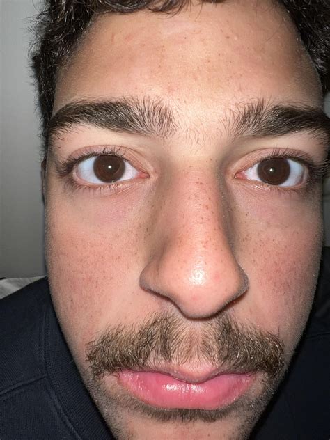 Last Day Of My 5 Month Accutane Treatment 80mg Day Before And
