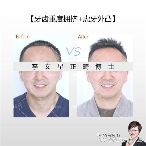 成都牙齿矫正丨隐适美矫正乱牙，重塑暖心笑容 知乎