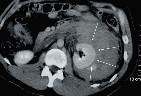 Hemorragia Retroperitoneal Espontánea No Traumática Efecto Del