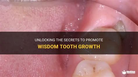 Unlocking The Secrets To Promote Wisdom Tooth Growth Medshun