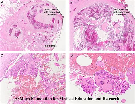 Papillary Endothelial Hyperplasia Mayo Clinic Proceedings