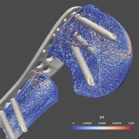 Computer Simulations Of Fracture Fixations In Osteoporotic Bones Cscs