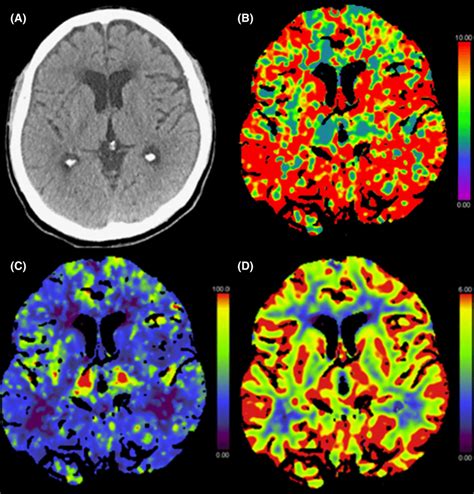 Initial Axial Non‐enhanced Computed Tomography Ct A Showing Normal
