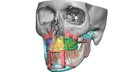 The Tremendous Potential Held By 3d Printing In Personalised Surgery