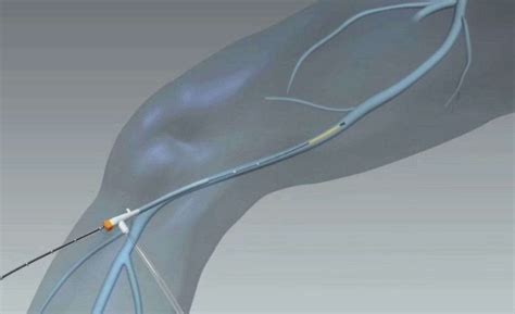 Closurefast™ Minimally Invasive Vein Treatment