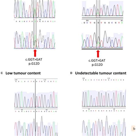 Sanger Sequencing For Kras Pg12g13 Mutation With Example Of A High