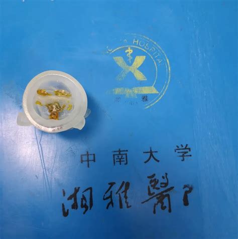 马克医疗3d打印辅助中南大学湘雅医院团队成功实施一例主动脉瓣置换手术 马克医疗