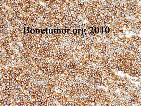Cd20 Stain
