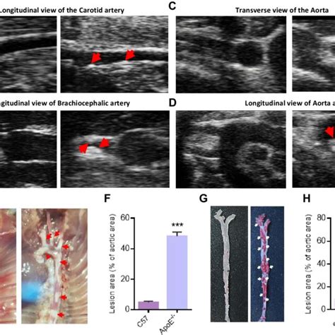 Atherosclerotic Plaque Model A Longitudinal View Of Carotid Artery