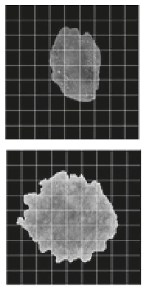 Activation Map For Vgg For An Example Of Melanoma First Row And For
