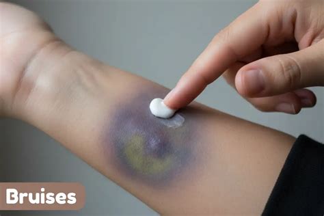 Bruises Ecchymosis Types Stages Symptoms And Healing Mayo Wellness