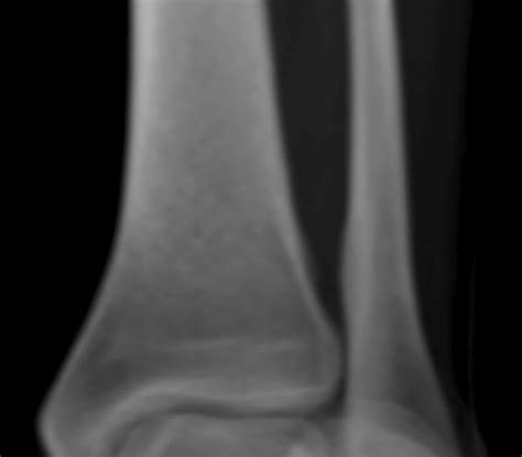 Distal Tibiofibular Radiological Overlap Bone And Joint