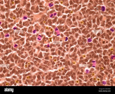 Primitive Neuroectodermal Tumor Light Micrograph Lm Of A Section Of