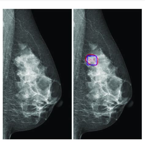 Pdf Classification Of Microcalcification Clusters Using Bilateral Features Based On Graph