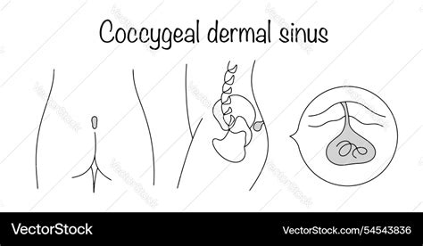 Coccygeal Dermal Sinus Royalty Free Vector Image