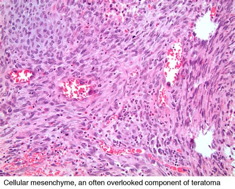 Pathology Outlines Teratoma