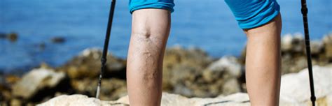 Varicose Vein Symptoms And The Myths Surrounding The Causes Bt Lifestyle