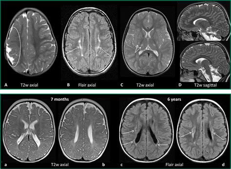 Normal Mri Brain Scan Sexiezpix Web Porn