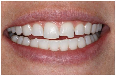 What Are My Options For Repairing A Chipped Tooth Your Dental Health Resource