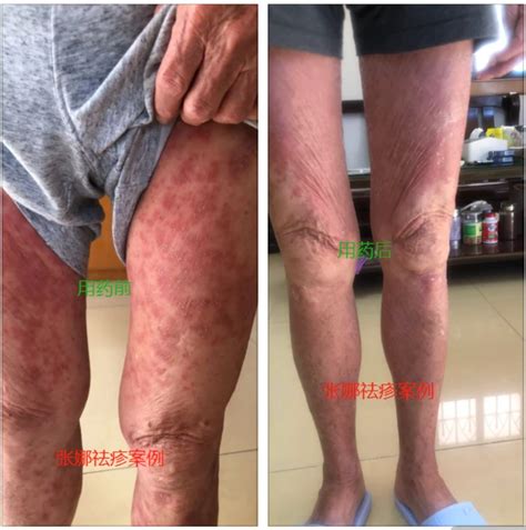 荨麻疹早期如何发现，治疗上怎么才能彻底？ 哔哩哔哩