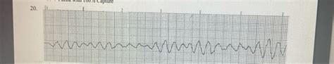 Ekg Flashcards Quizlet