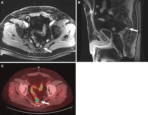 Comparison Of Imaging Modalities For Pelvic Lymph Node Recurrence A Download Scientific