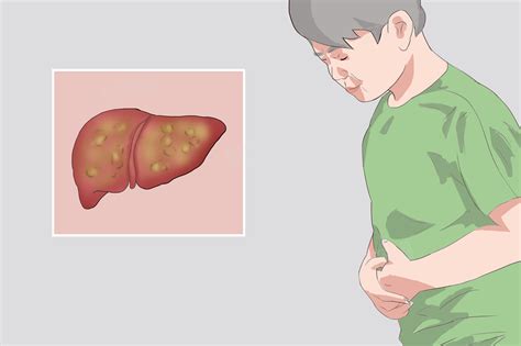 肝硬化早期的6个表现