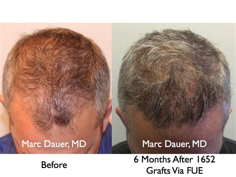 Fue Hair Transplant Results And Donor Zone After 6 Months Marc Dauer