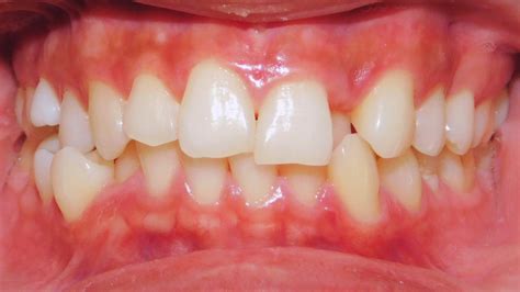 Class Ii Malocclusion Deep Overbite Severe Upper Lower Crowding