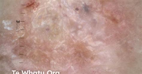 Superficial Basal Cell Carcinoma Polarised Dermoscopy View Image