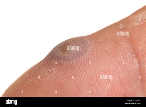 Blister After Wart Is Frozen