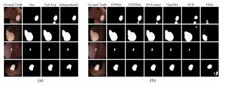 Tri Branch Feature Pyramid Network Based On Federated Particle Swarm Optimization For Polyp