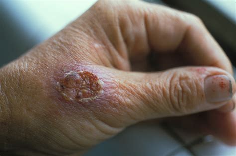 O Que é Leishmaniose Tegumentar Nazaedu