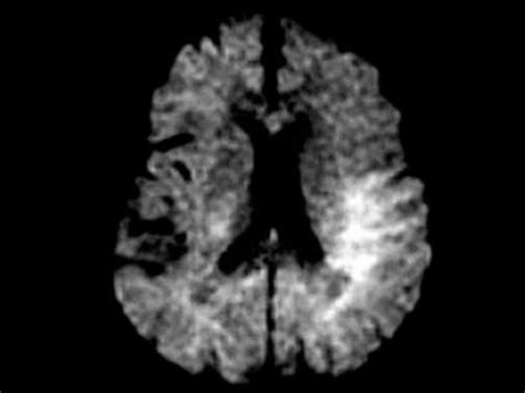 Acute Ischemic Stroke General Approach Neupsy Key