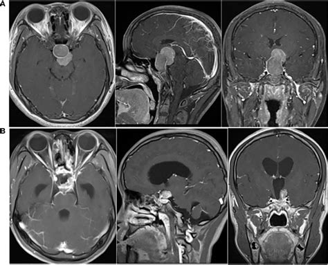 Pituitary Tumor Mri