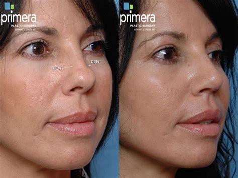 Revision Rhinoplasty Before And After Pictures Case 224 Orlando