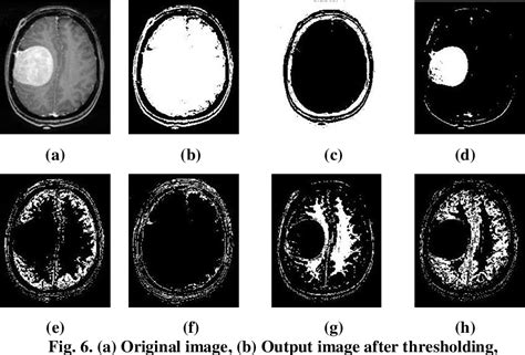 Figure 6 From Brain Tumor Detection Based On Asymmetry And K Means Clustering Mri Image