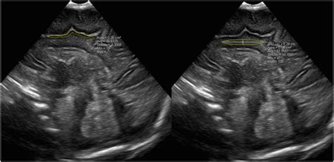 Sample ‘regions Of Interest Positioned Within The Cortical Gray Matter Download Scientific