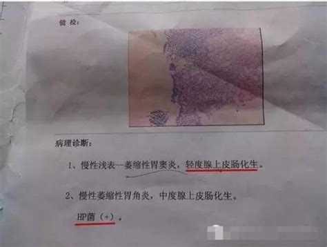 胃癌胃镜结果胃胃镜胃胃镜检查图片大山谷图库