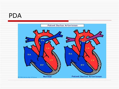 Ppt Congenital Heart Disease Chd Powerpoint Presentation Free Download Id 761486