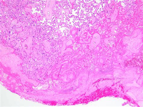 Retroplacental Bleeding