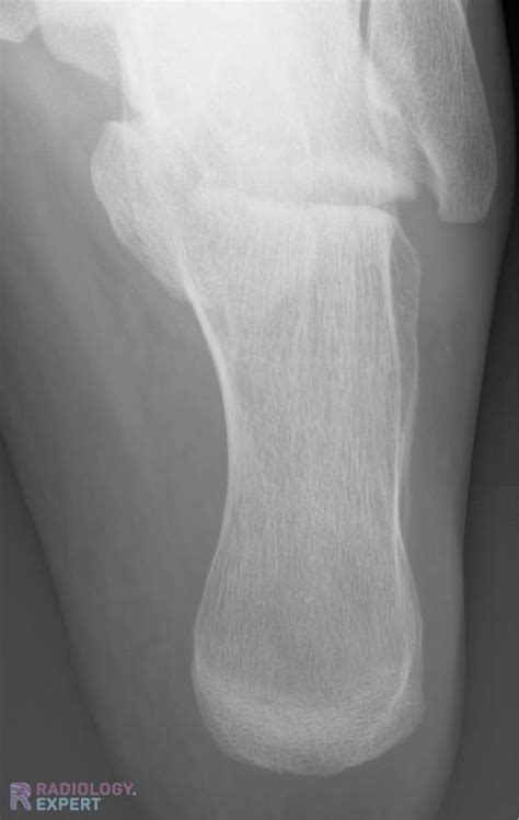 X Ankle