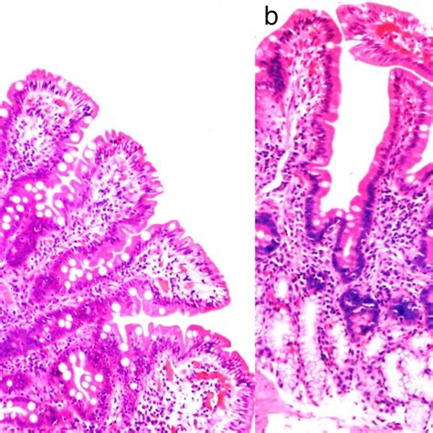 A Duodenal Mucosa Showing Partial Villous Atrophy In Systemic