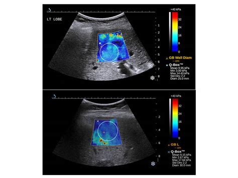 Facilities Fibroscan Liver Test Elastography And Pediatric Endoscopy