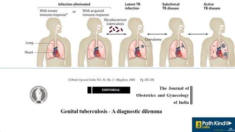 Female Genital Tuberculosis Pptx