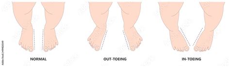 Malformation W Sit Injury Bow Leg Genu Valgum Varum Flat Duck Out Turn