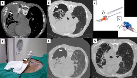 Management Of Pneumothorax Biopsy Of Peripheral Lung Mass Arrow Download Scientific